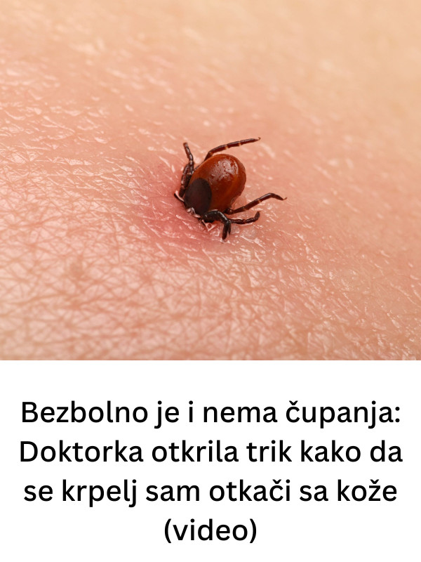 BEZB0LN0 JE l NEMA ČUPANJA: Doktorka otkrila trik kako da se krpelj sam ...